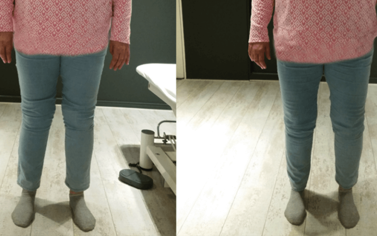 Heupartrose, wel of geen operatie? - Fysio Physics